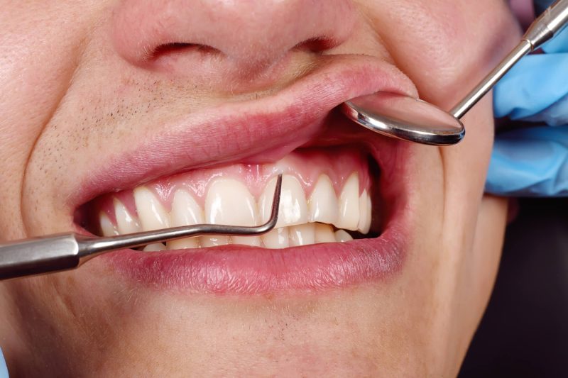How Stress Affects Your Gums | Richard Newhart, DDS