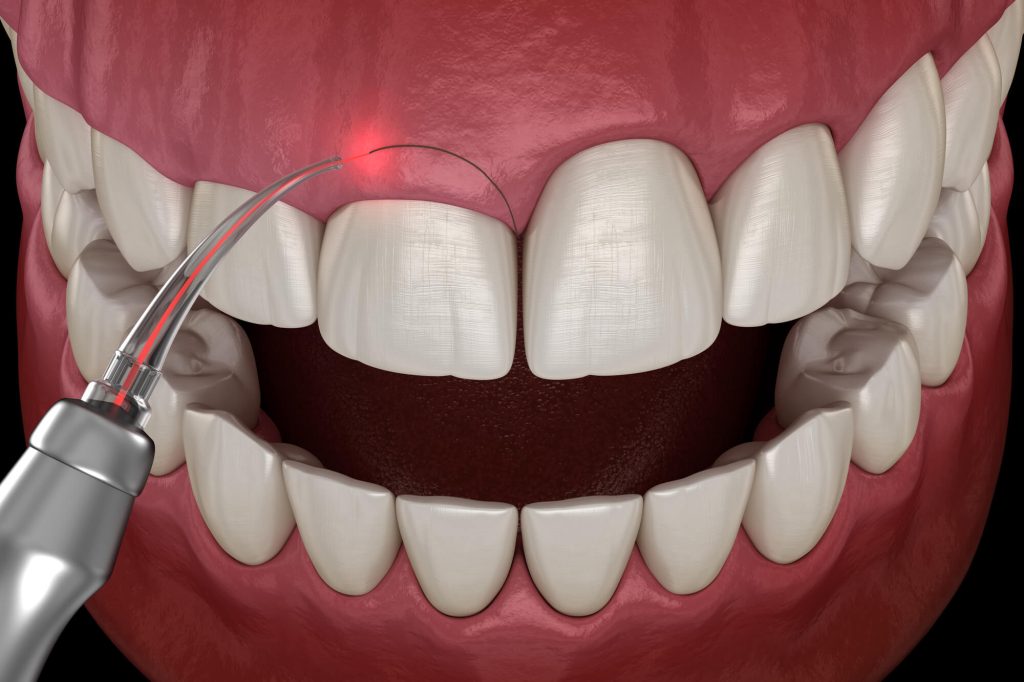 Healing Time and Recovery Tips After Gingivectomy | Richard Newhart, DDS